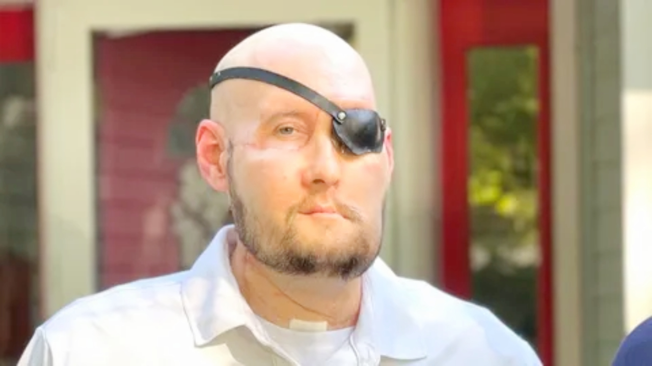 Este es el primer paciente de trasplante de ojo y cara en el mundo | QPASA